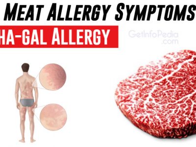Symptoms of Alpha-gal Allergy Archives - Getinfopedia.com